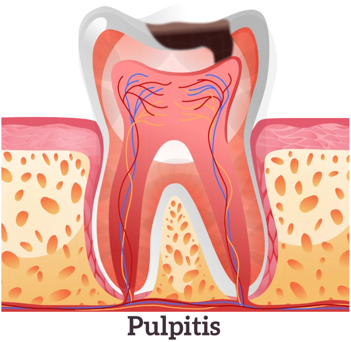 Tooth Pulpitis: What It Is, Symptoms, Diagnosis, and Treatment Methods
